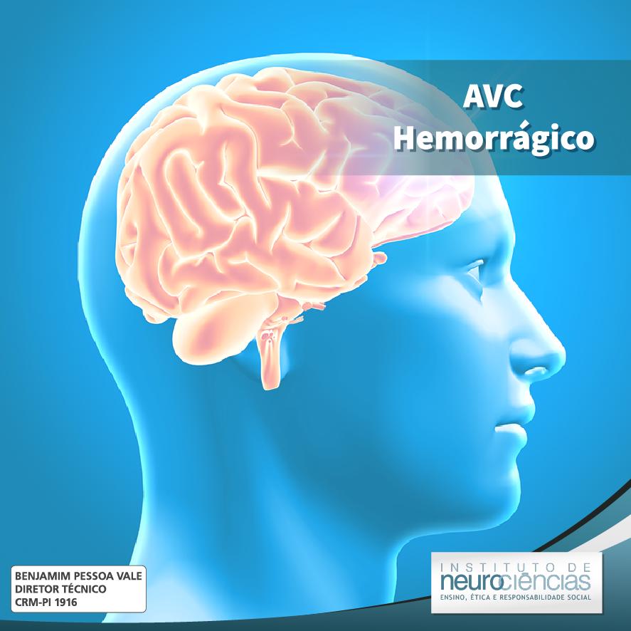 AVC hemorrágico – INSTITUTO DE NEUROCIÊNCIAS